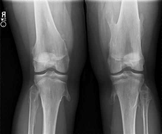 Osteochondroma & Multiple Hereditary Exostosis - Pathology - Orthobullets